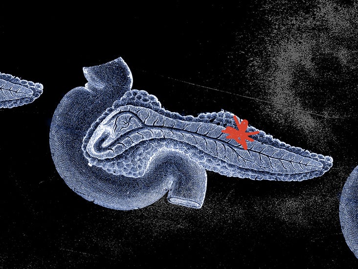 Exocrine pancreatic insufficiency: Symptoms, diagnosis, and more