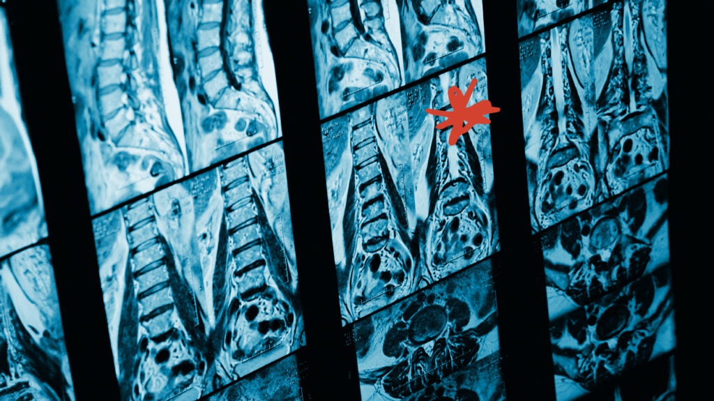 Anterolisthesis: Symptoms, causes, and treatment