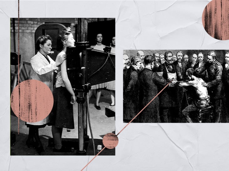 Tuberculosis history: Origins, testing, treatments, and more